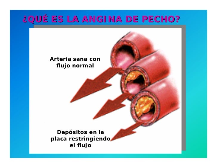 Semiología de la Angina de Pecho