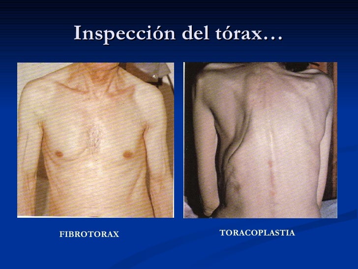 Semiología neumonológicarlistoya