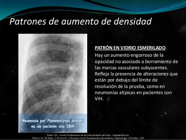 Semiología radiológica en neumología