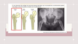 Semiología Radiológica Epifisiólisis femoral .pptx