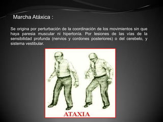 Marcha Atáxica