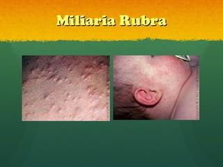 Histología De La Miliaria Rubra