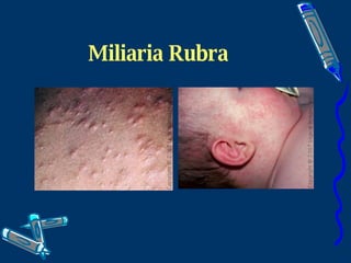Histología De La Miliaria Rubra