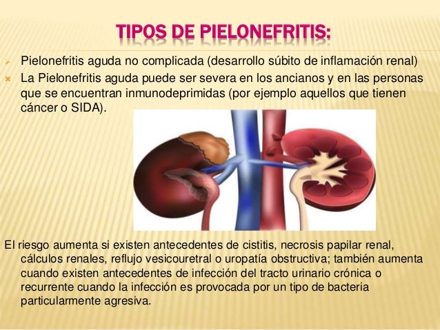 ¿Qué Es La Pielonefritis? Síntomas Y Tratamiento – FSQRD