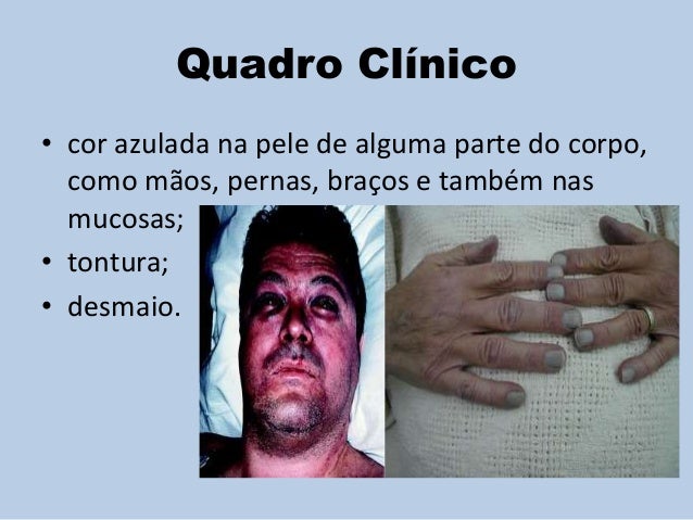 Semiologia da cianose