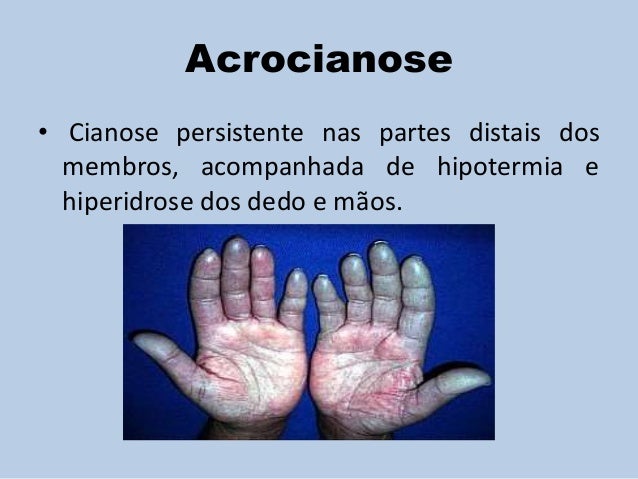 Semiologia da cianose