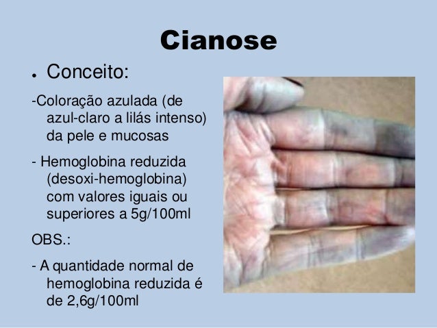 Semiologia da cianose