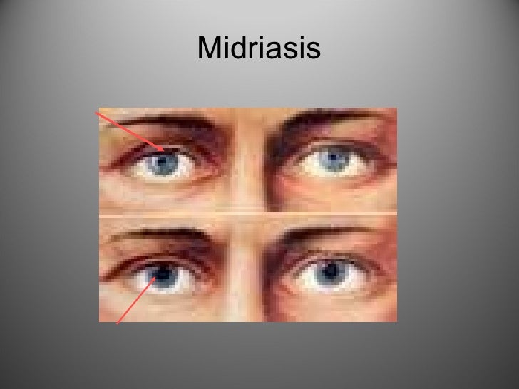 Miosis Y Midriasis