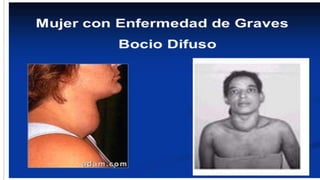 Semiologia del bocio | PPTX