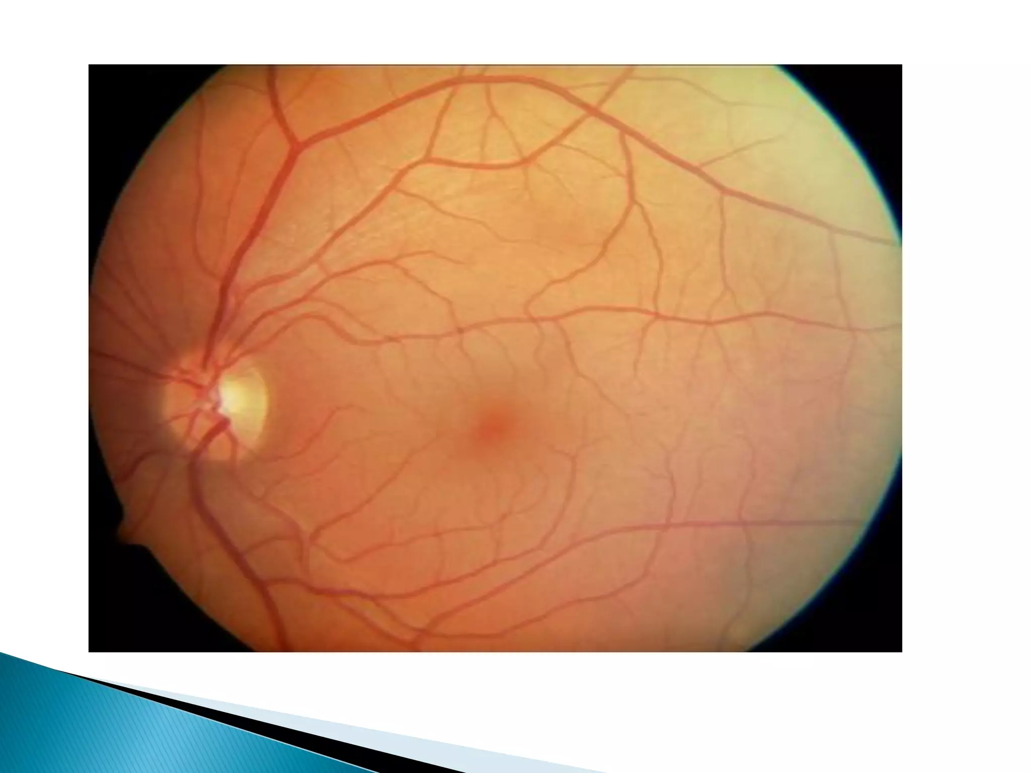 Semiologia del ojo . Exploracion Semiologica de II, III, IV y VI par ...