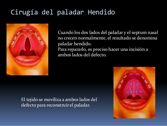 Semiologia del paladar