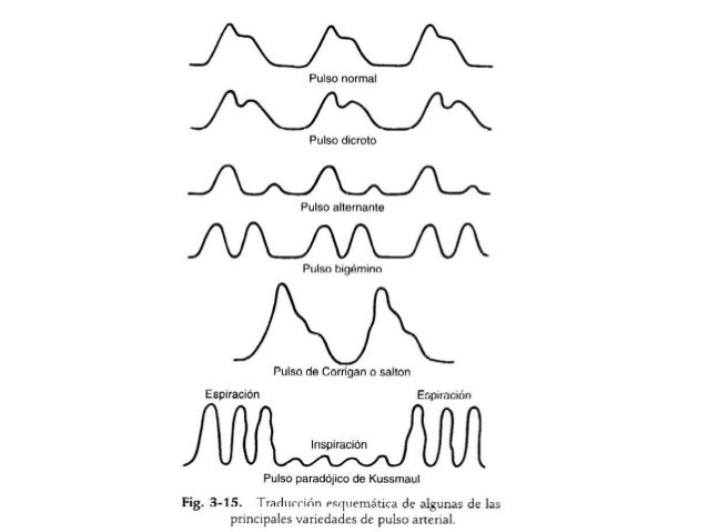 Semiologia del pulso