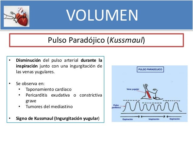 Semiologia del pulso