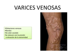 semiologia del sistema vascular periferico Ruth.pptx