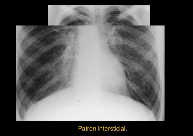 Tac Torax Patron Nodular