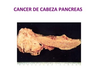 Semiologia de pancreas y vias biliares | PPT