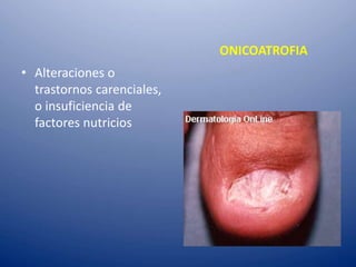 SEMIOLOGIA DE PIEL LESIONES DE UÑAS.ppt