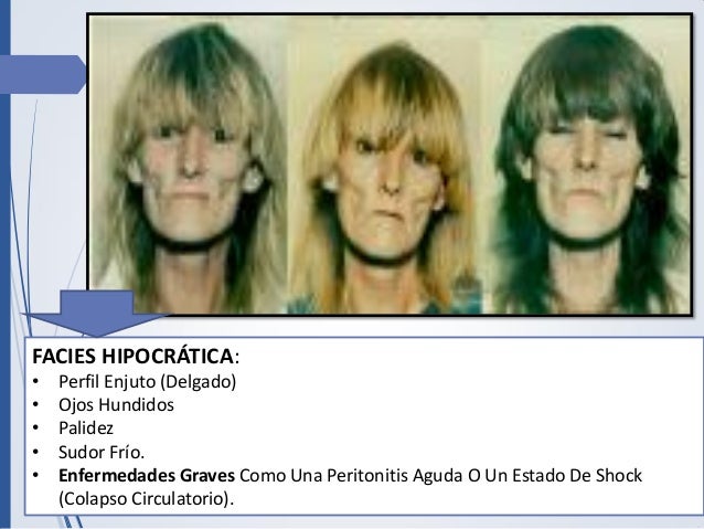 Facies Hippocratica