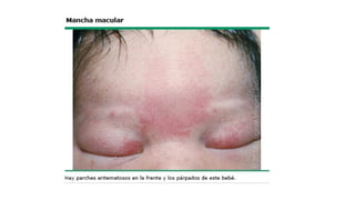 SEMIOLOGIA NEONATAL SIGNOS DE ALARMA.pptx