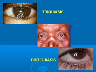 Semiología_ocular | PPT