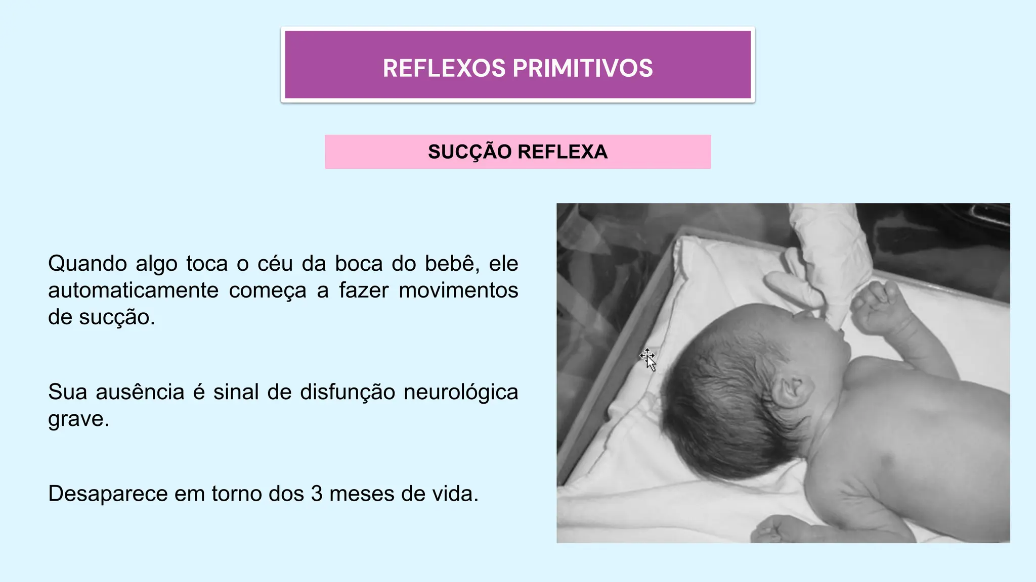 SEMIOLOGIA PEDIÁTRICA NEUROLÓGICA - Reflexos | PDF