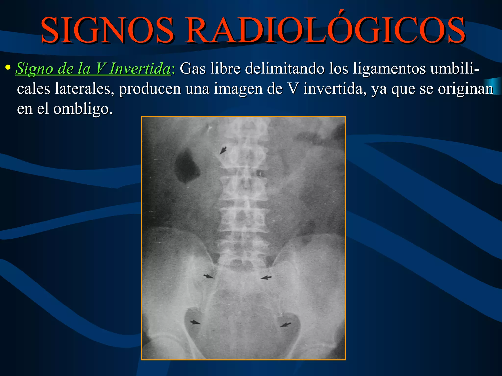 Semiologia radiologica del neumoperitoneo | PPT