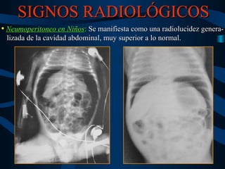 Semiologia radiologica del neumoperitoneo | PPT