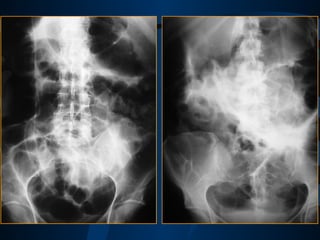 Semiologia radiologica del neumoperitoneo | PPT