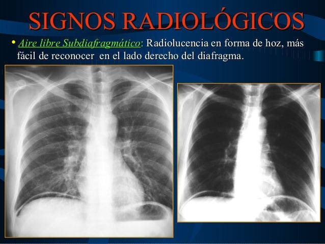Semiologia radiologica del neumoperitoneo