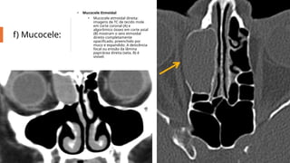 semiologia radiologica seios da face.pptx