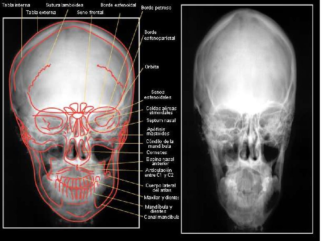 Semiologia y radiologia de senos paranasales