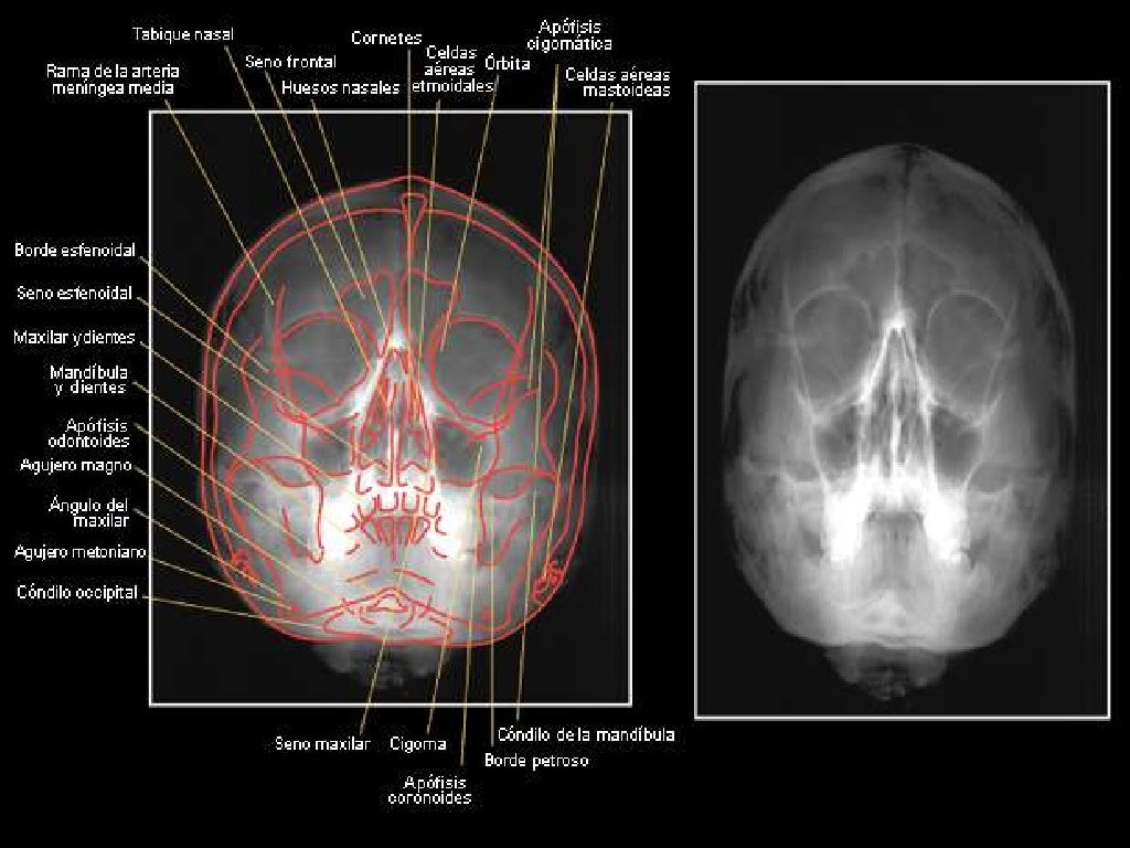 Semiologia y radiologia de senos paranasales