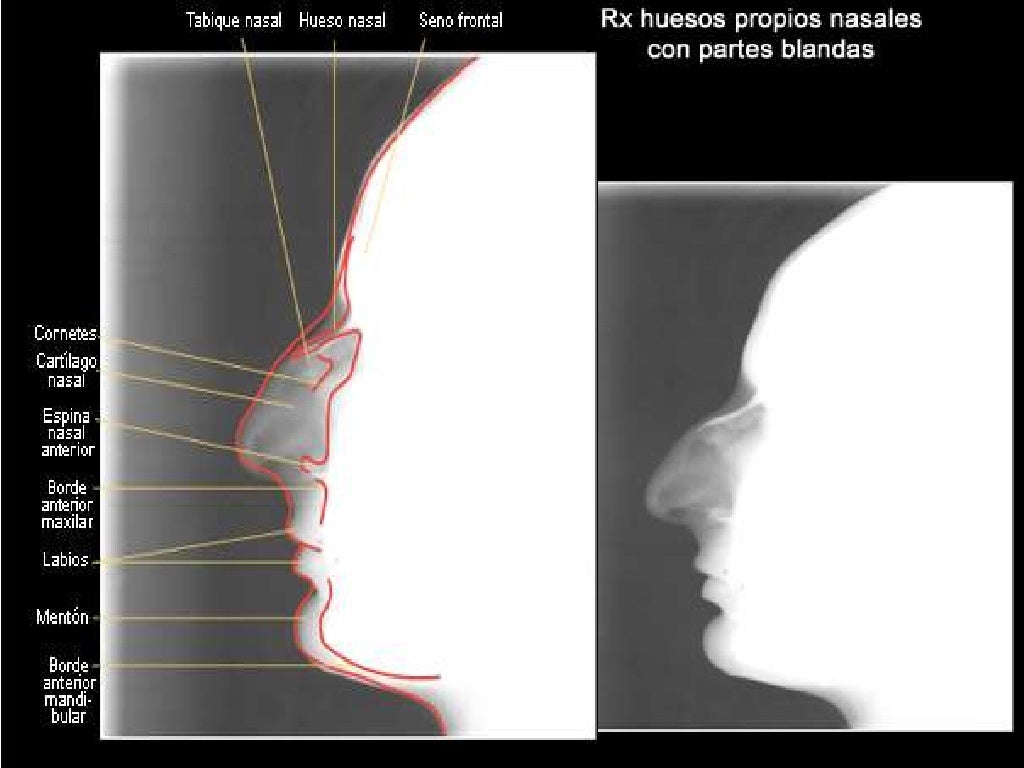 Semiologia y radiologia de senos paranasales