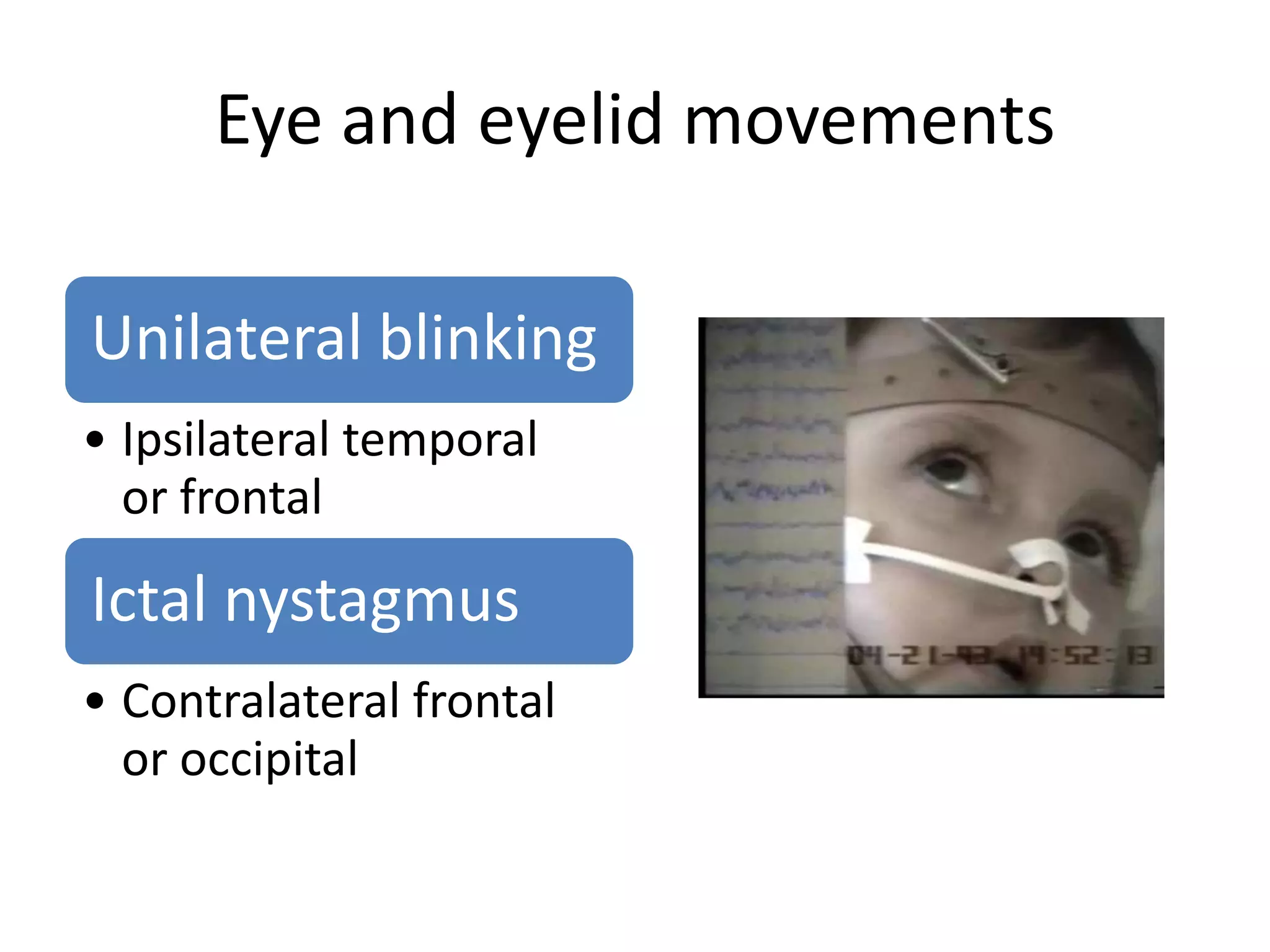 Semiology of seizures | PPTX