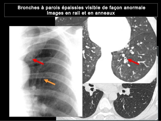 Semio radio thorax