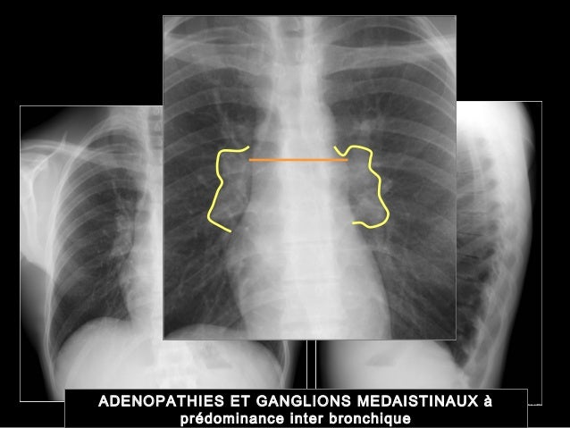 Semio radio thorax