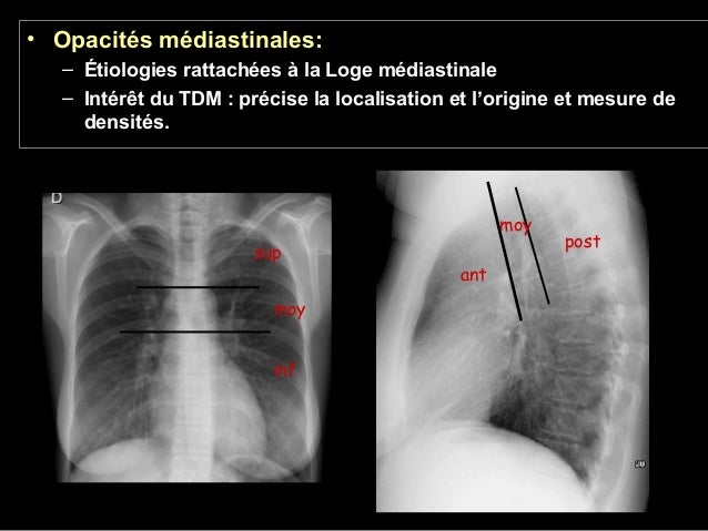 Semio radio thorax