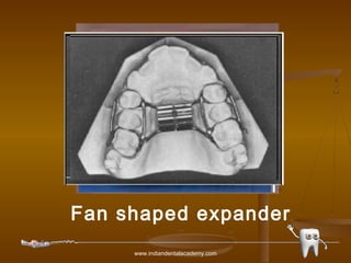 Semirapid maxillary expansion | PPT