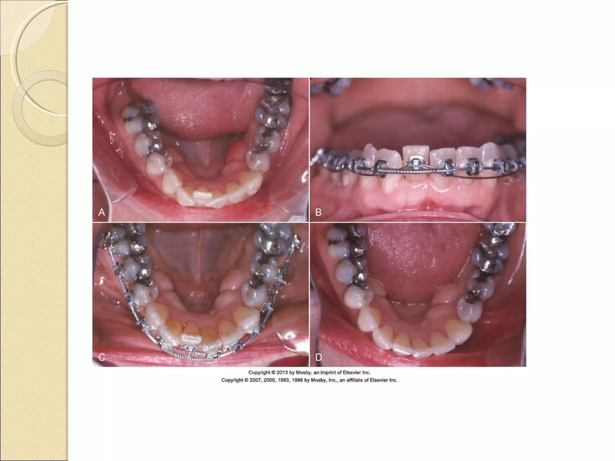 leveling and aligning in orthodontics | PPT