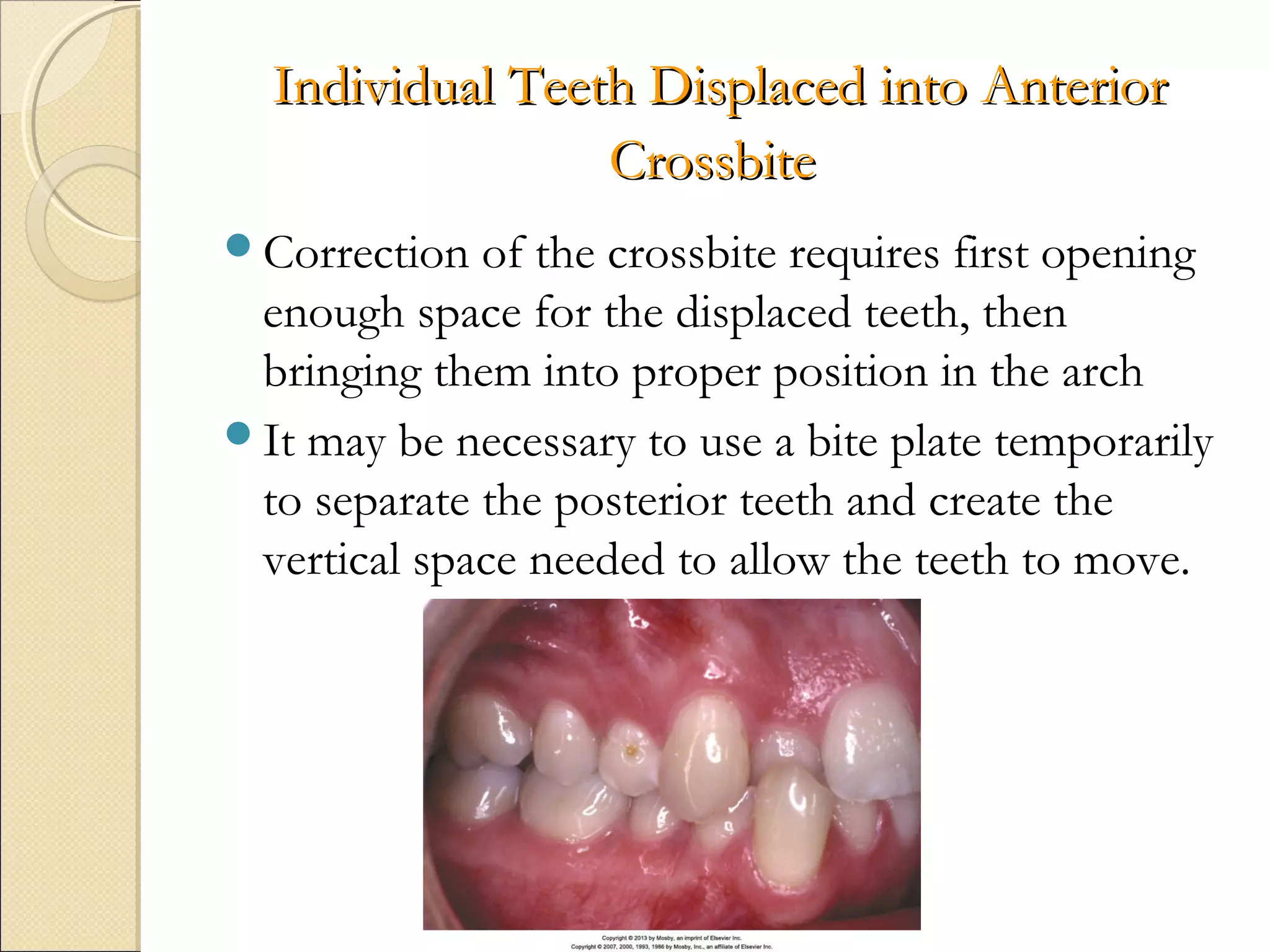leveling and aligning in orthodontics | PPT