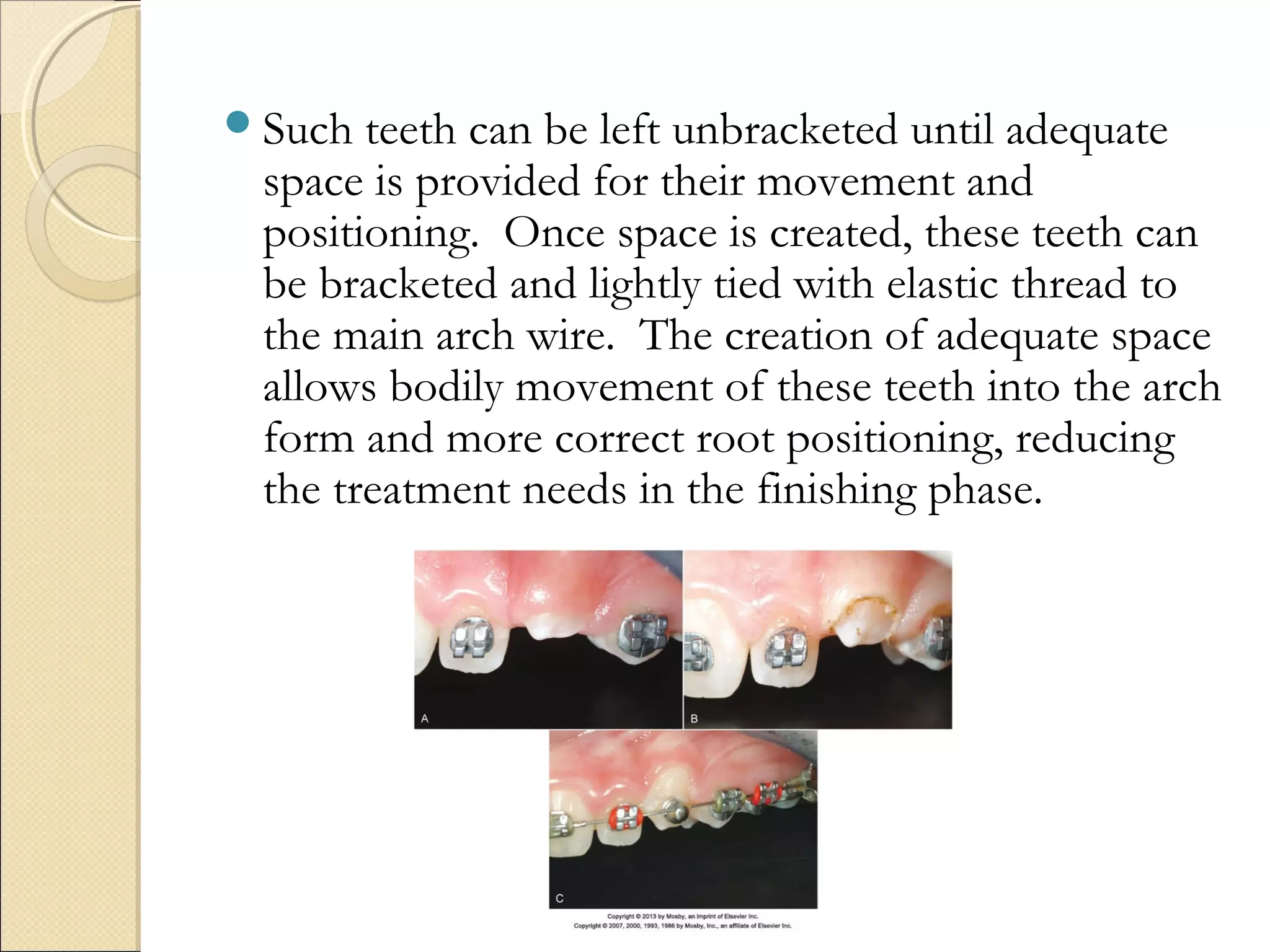 leveling and aligning in orthodontics | PPT