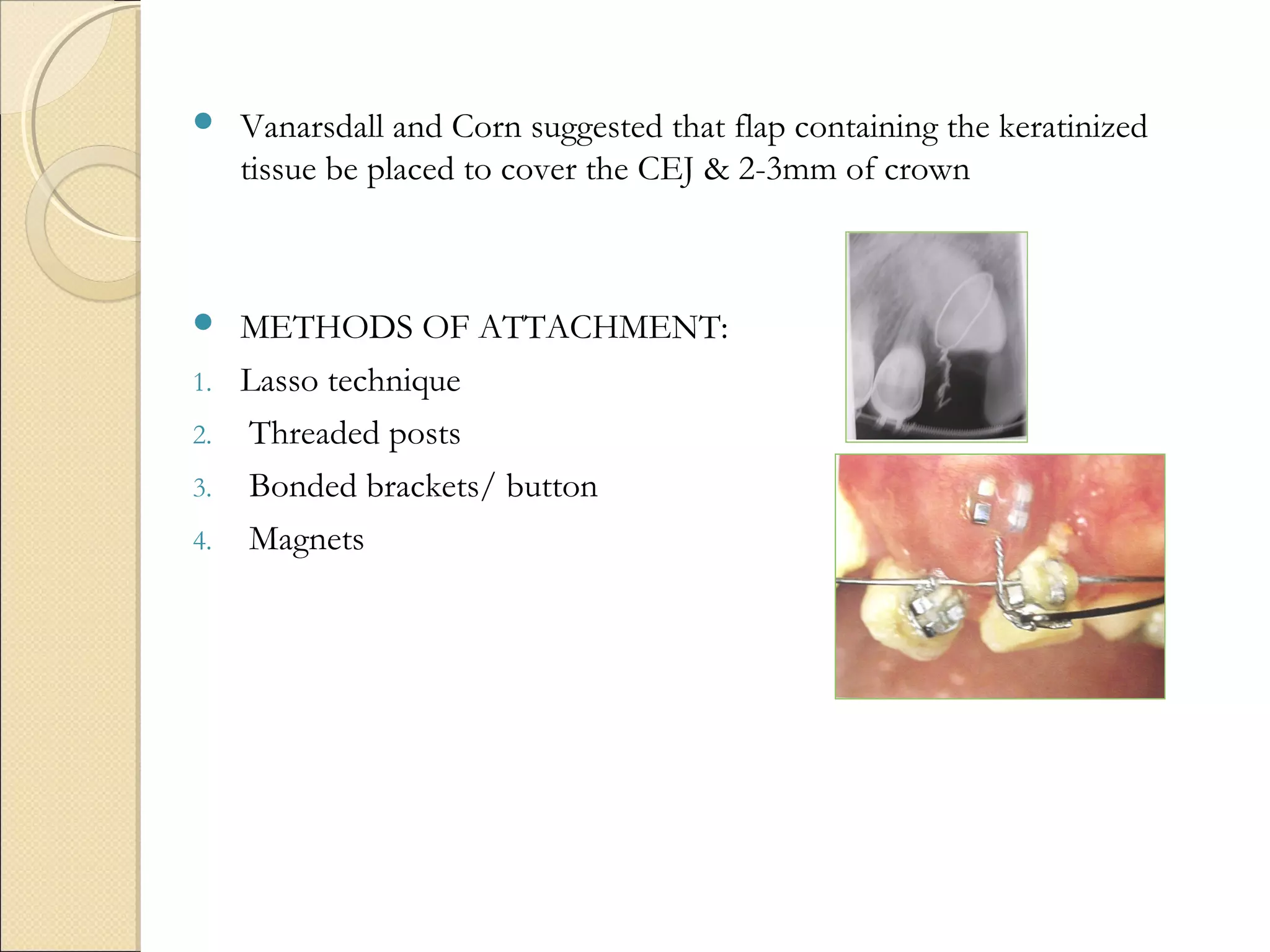leveling and aligning in orthodontics | PPT