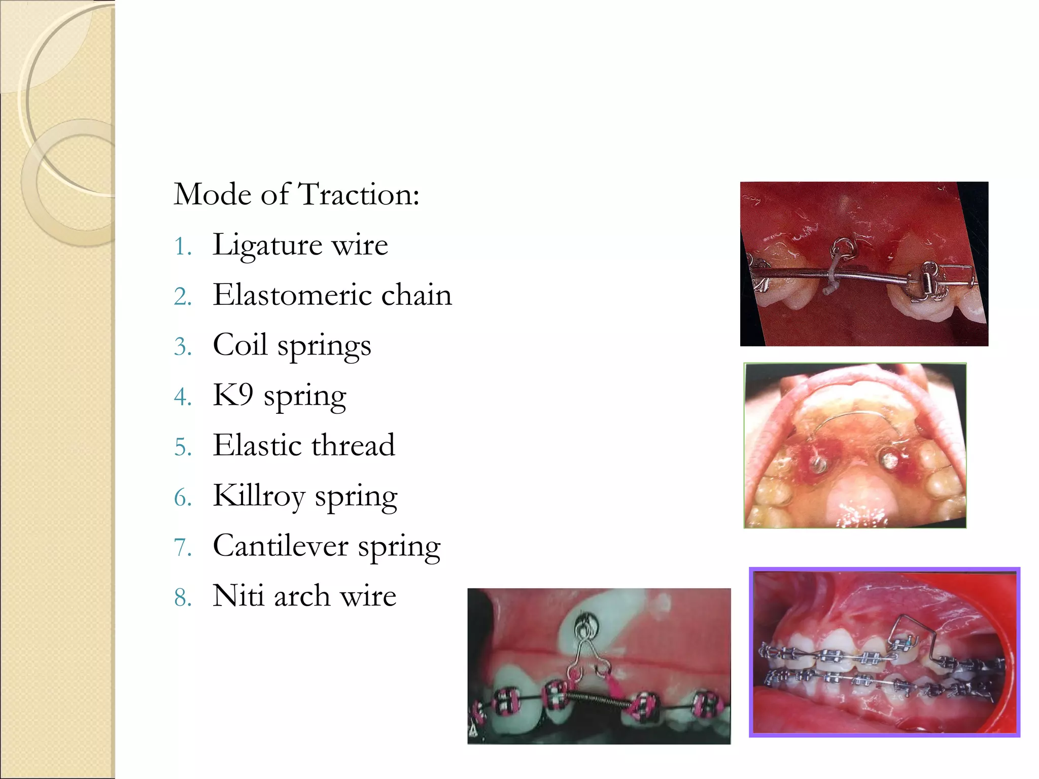 leveling and aligning in orthodontics | PPT