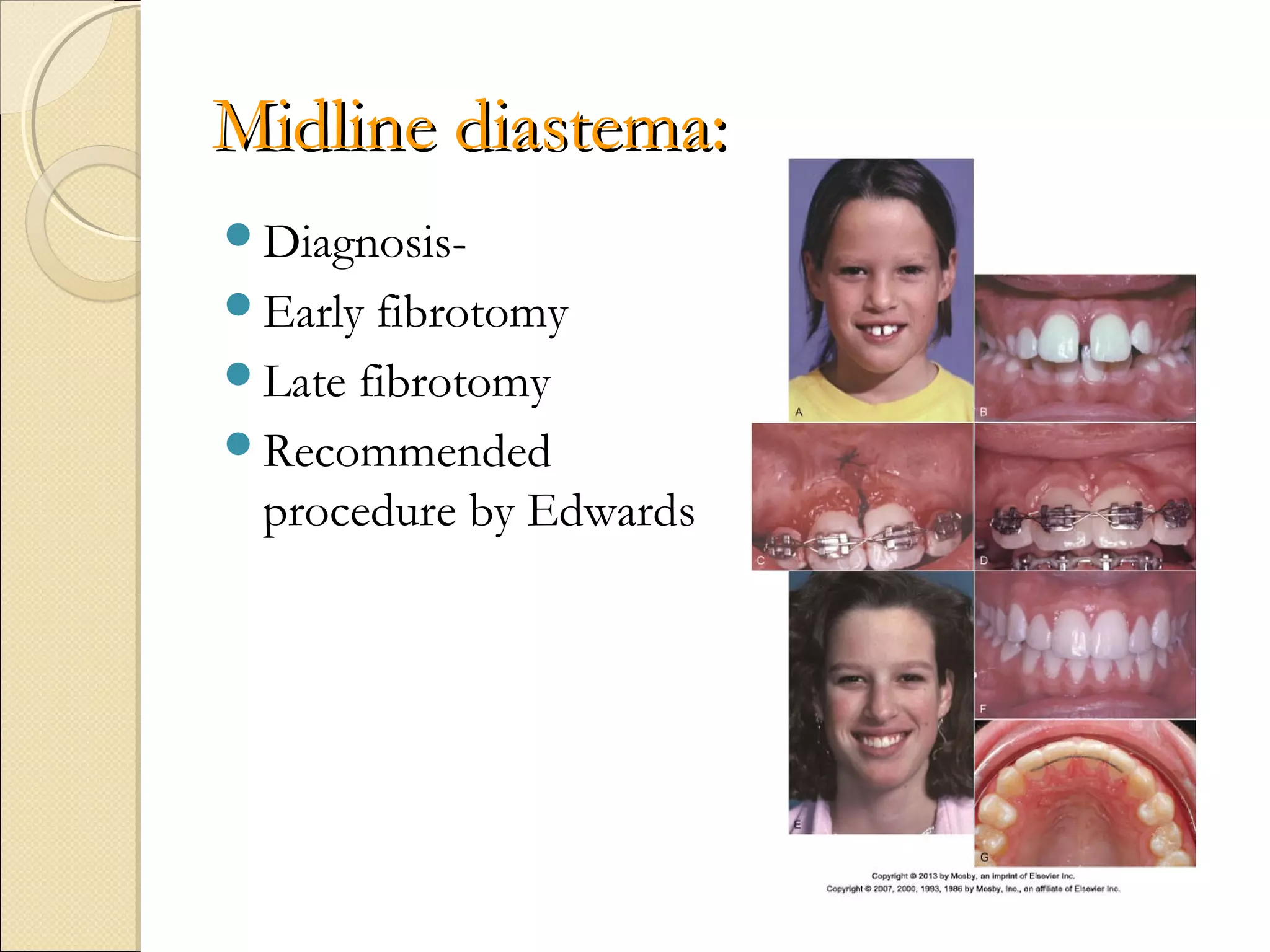 leveling and aligning in orthodontics | PPT