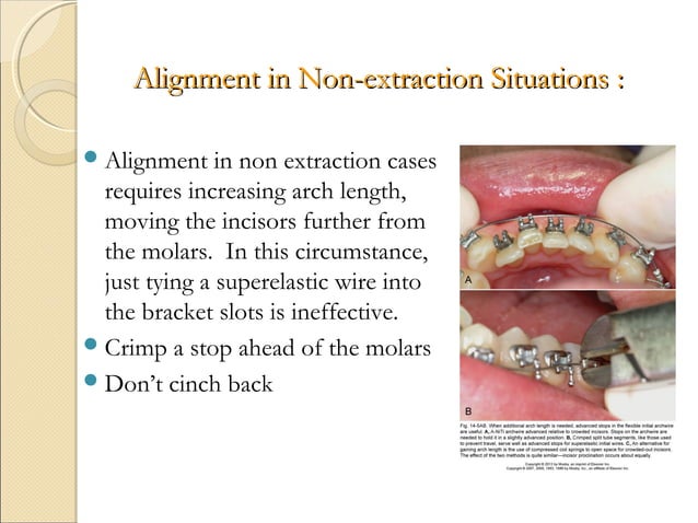 leveling and aligning in orthodontics | PPT