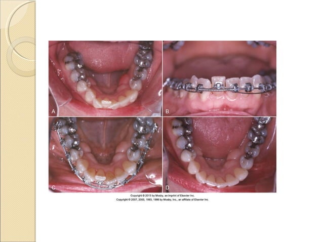 leveling and aligning in orthodontics | PPT