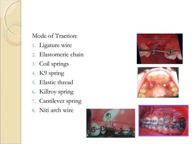 leveling and aligning in orthodontics | PPT