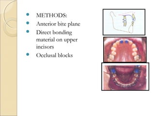 leveling and aligning in orthodontics | PPT