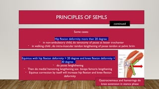 Single Event Multi Level Surgery for Cerebral Palsy | PPTX