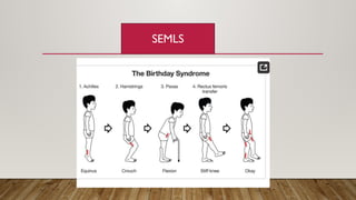Single Event Multi Level Surgery for Cerebral Palsy | PPTX
